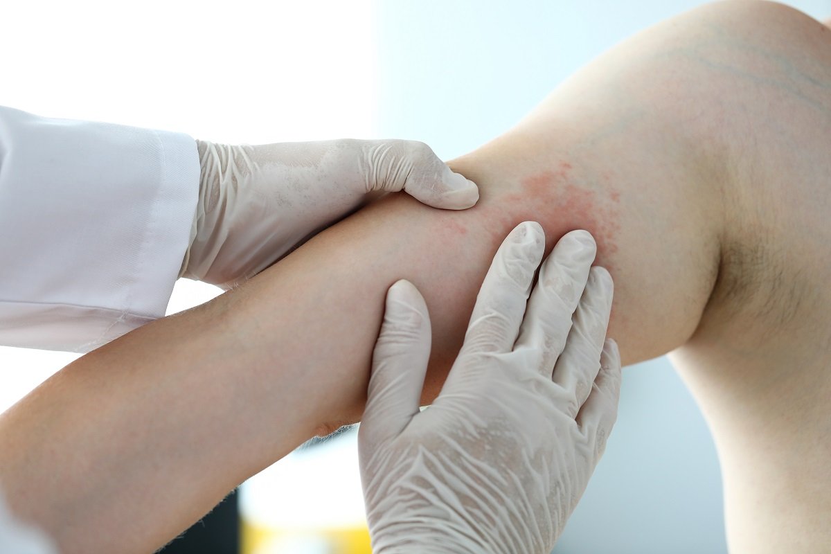 Óleos Essenciais para Cobreiro (Herpes Zóster) - Protocolos